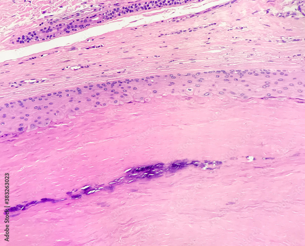 Trichilemmal cyst reveals squamous epithelial lining without granular ...