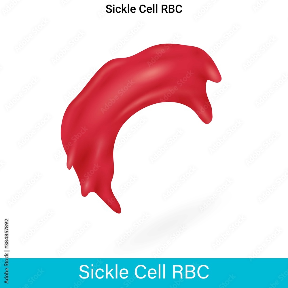 Sickle cell shape in sickle cell anemia disease vector illustration ...