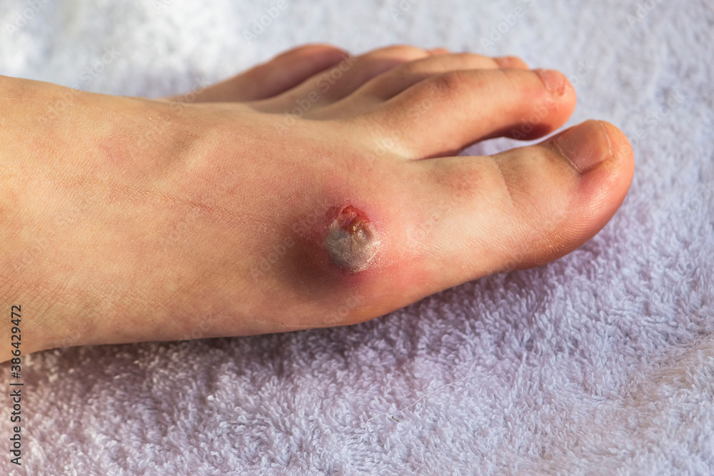 Diabetes mellitus of the foot. Infected wound, treatment of a diabetic ...