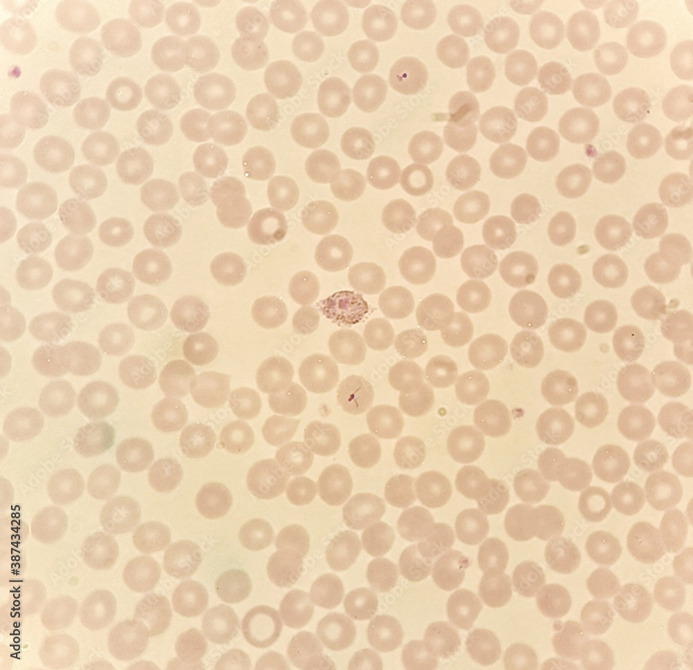 Under 100X light microscope, human parasite on thin film of blood smear ...