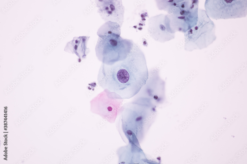Photo Stock View in microscopic of Abnormal human cervix cells.Squamous ...