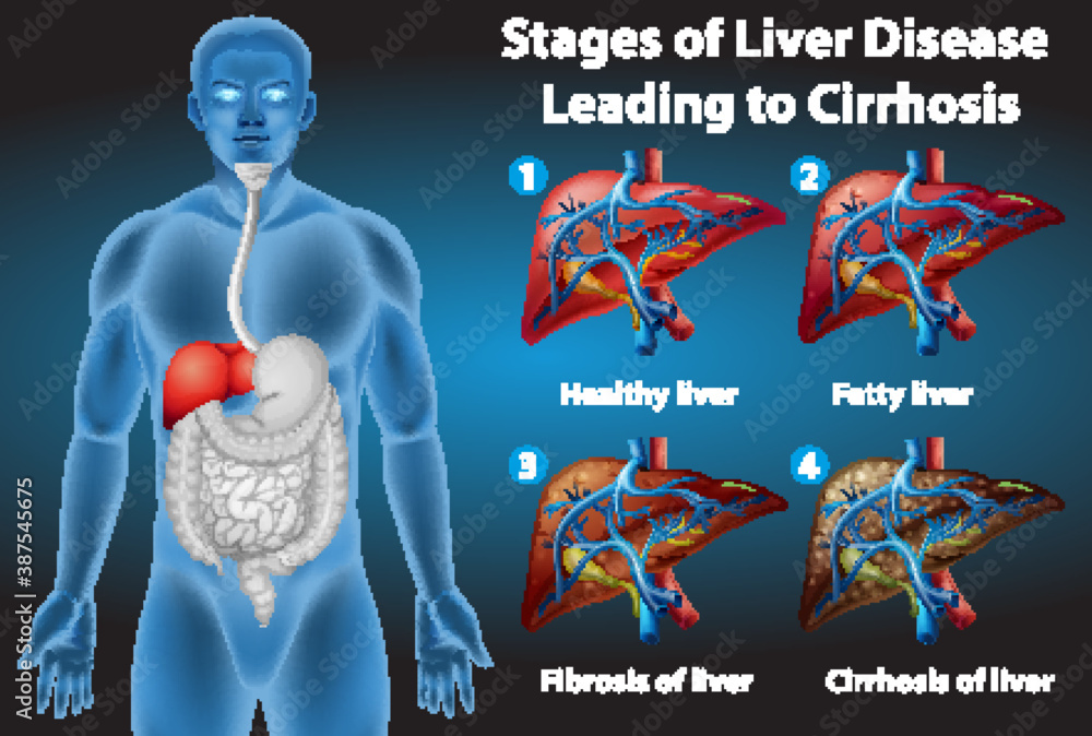 Stages of liver disease Stock Vector | Adobe Stock