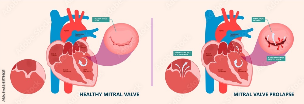 Cath Lab Atrial Septal Defect Tetralogy of Fallot Patent Foramen Ovale ...