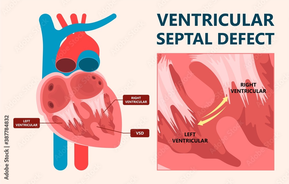 Cath Lab Atrial Septal Defect Tetralogy of Fallot Patent Foramen Ovale ...