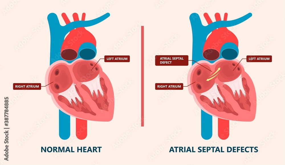 Cath Lab Atrial Septal Defect Tetralogy of Fallot Patent Foramen Ovale ...