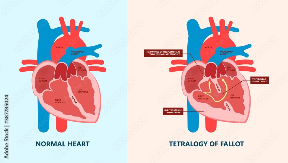 Vector de Stock Cath Lab Atrial Septal Defect Tetralogy of Fallot ...