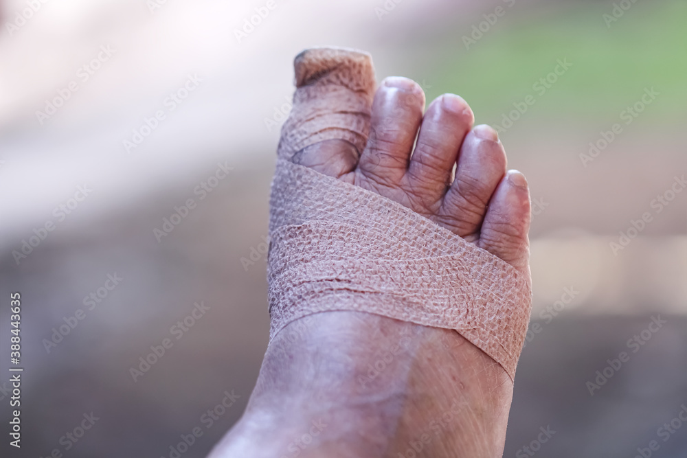 Splint foot , Asian woman big toe injury with medical splint and ...