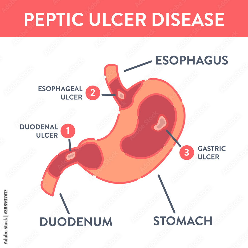 Stock-Vektorgrafik „Peptic ulcer stomach disease infographic poster ...