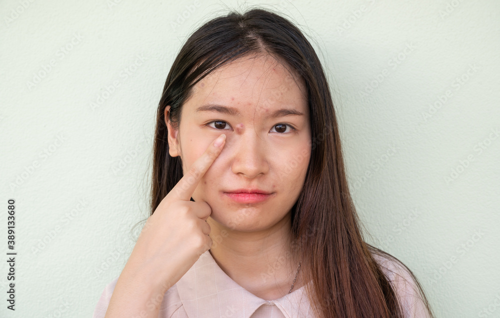 Stock-Foto „Asian woman pointing hard pimple (or Elephant head acne ...