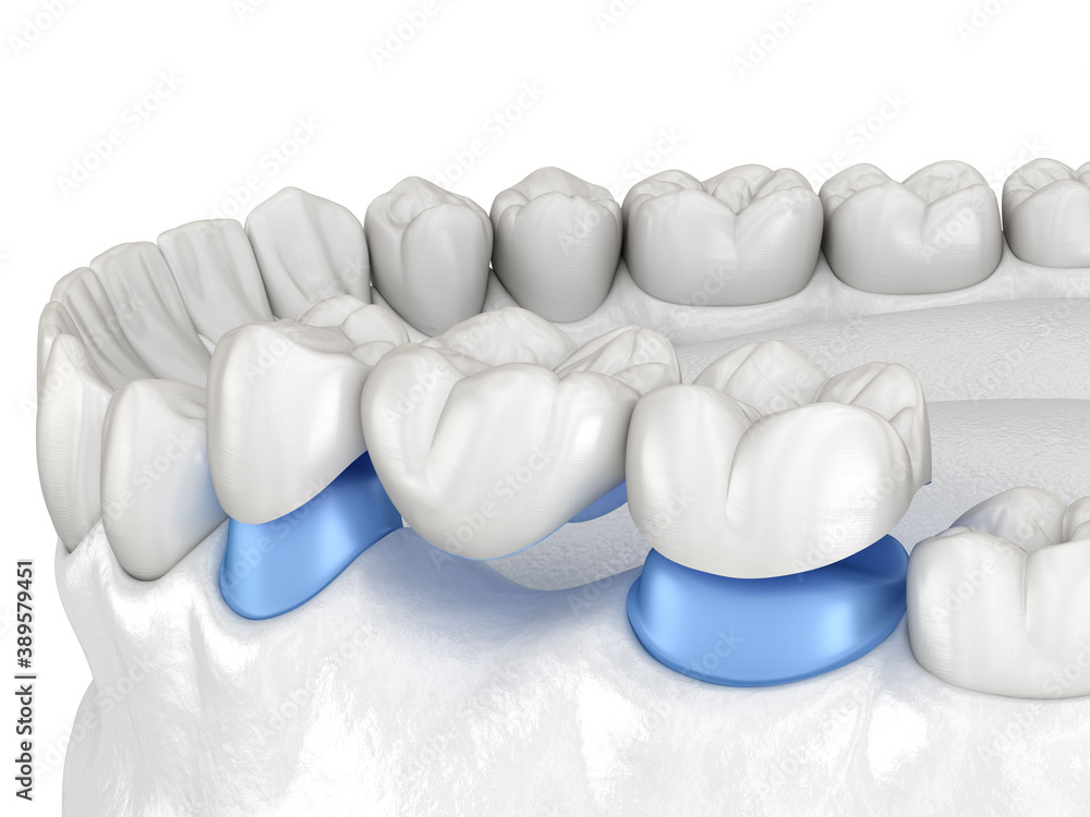 Porcelain Dental bridge of 3 teeth over molar and premolar. Medically ...