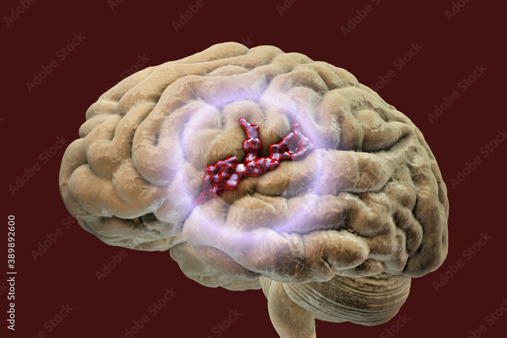 Hemorrhagic stroke, 3D illustration. Hemorrhage on the brain surface ...