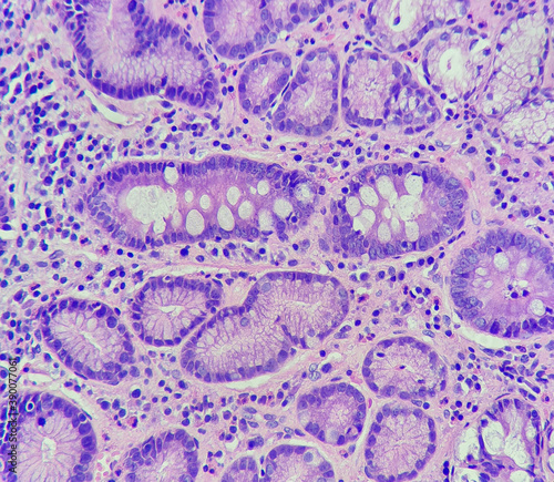 This gastric mucosa reveals focal intestinal metaplasia, magnification ...
