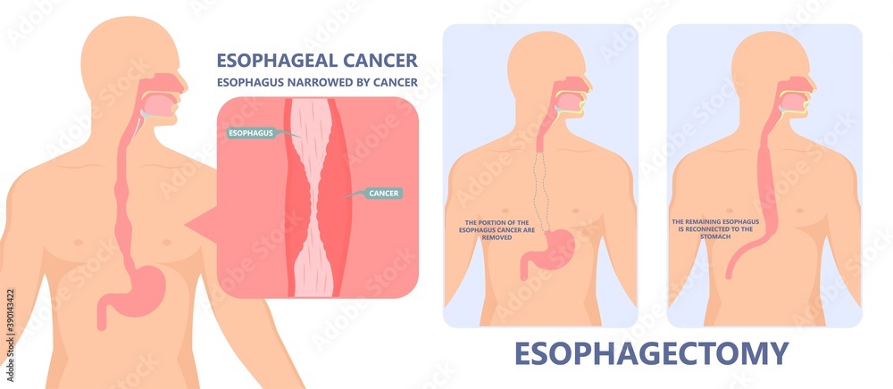 Dysphagia infection trachea examine Surgery choking gastric symptoms ...