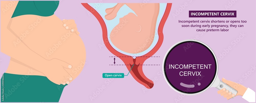 Incompetent cervix cervical insufficiency weak tissue premature stitch ...
