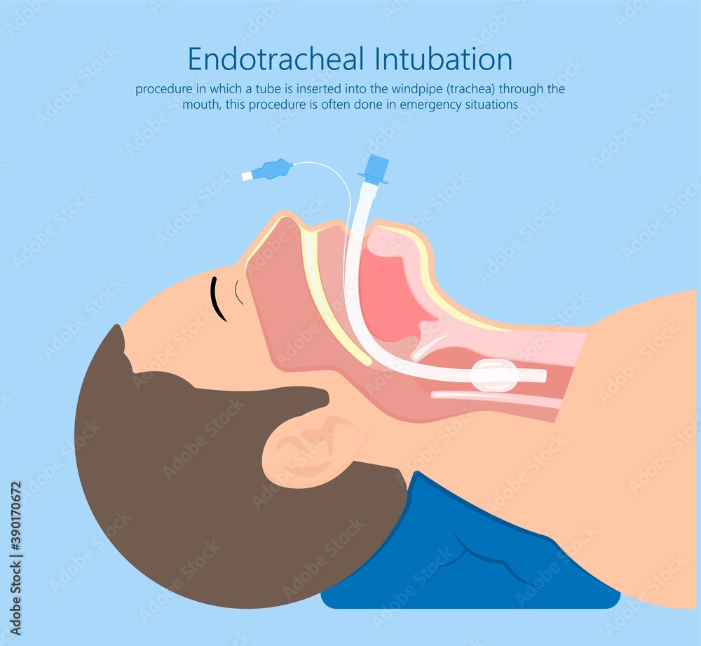 Endotracheal intubation ICU care unit COVID 19 larynx throat rescue ...