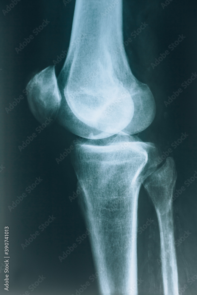 Foto de Stock X-ray of the leg. Leg bones, joint disease, bone injury ...