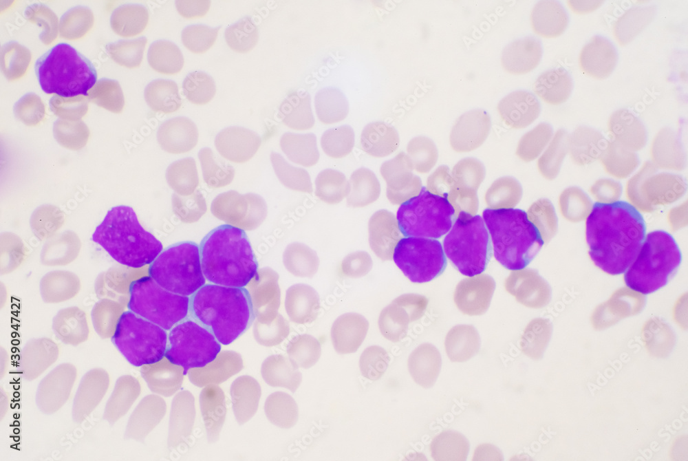blast cell of white blood cells in blood smear. Stock Photo | Adobe Stock