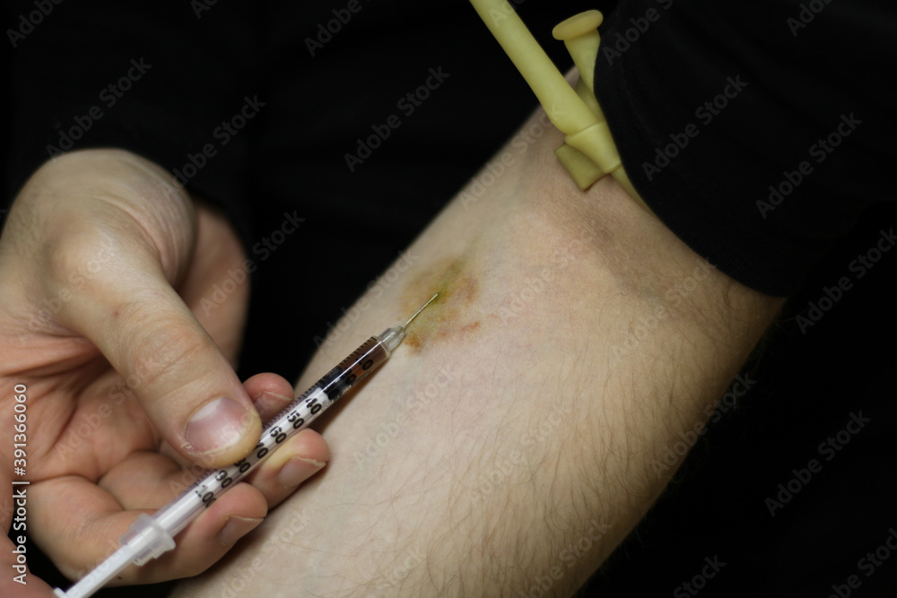 Front and close view of the hematoma arm of a cocaine addict man, while ...