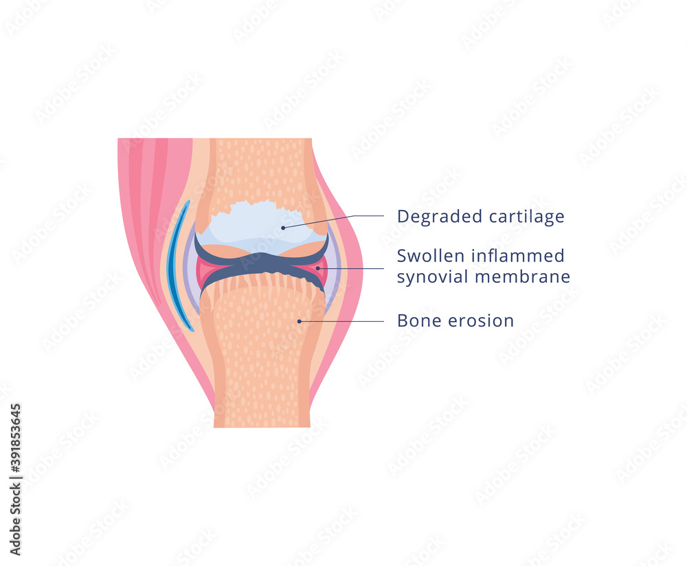 Diagram of knee joint with osteoarthritis, flat vector illustration ...