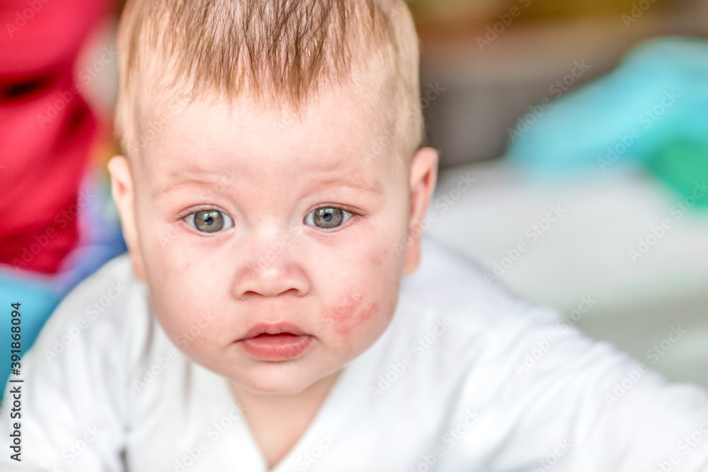Atopic dermatitis eczema in baby.Condition that causes the skin to ...