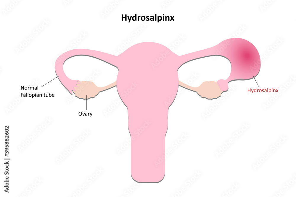 Hydrosalpinx diagram, Obstructed Follopian tube Stock Vector | Adobe Stock