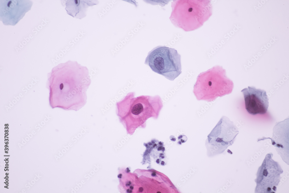 View in microscopic of Abnormal human cervix cells.Squamous epithelium ...