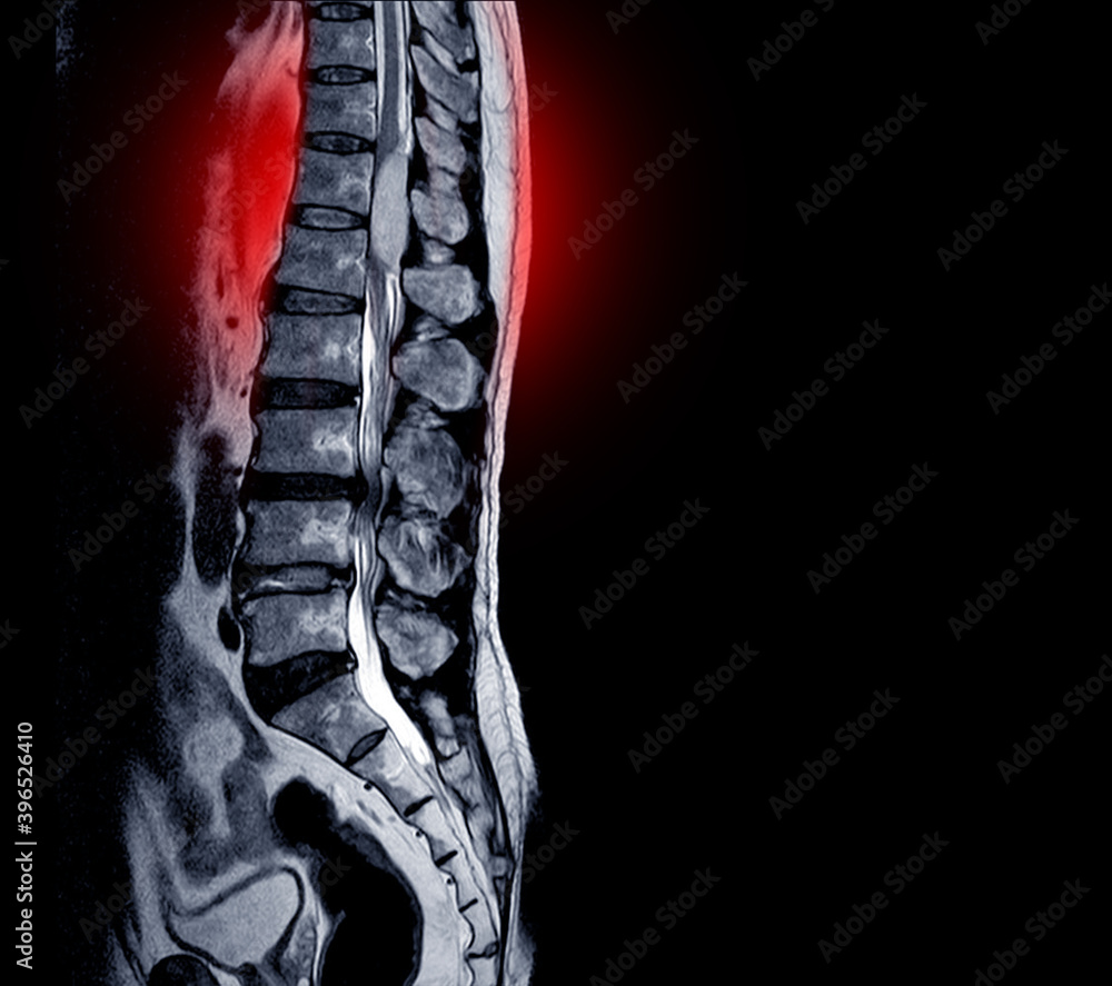 Photo Stock MRI scan of lumbar spines of a patient finding Spinal mass ...