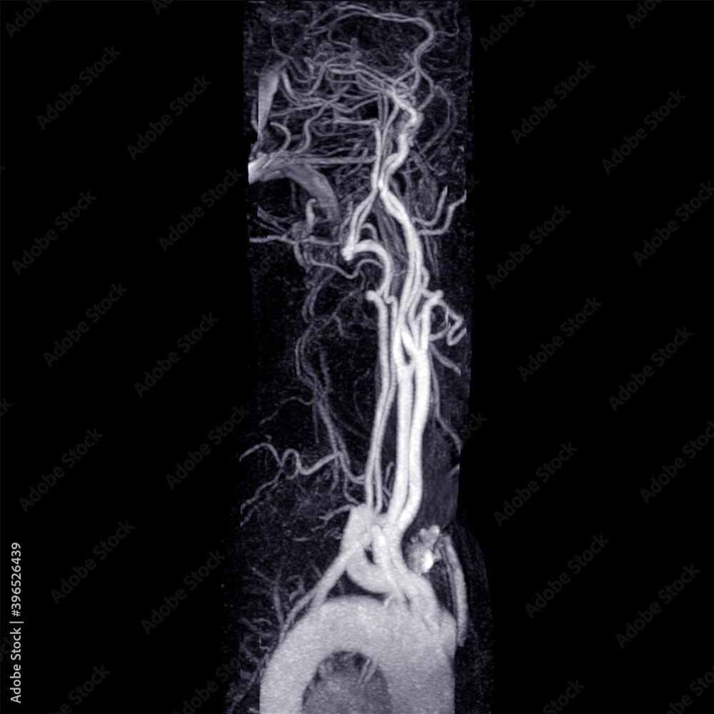 Soft and blurry image,Medical image MRI(magnetic resonance venography ...