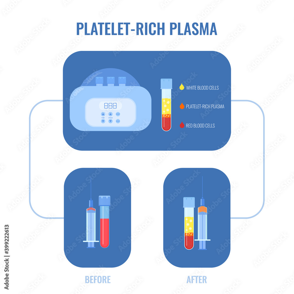 Blood after separation of platelets in the centrifuge. PRP test tube ...