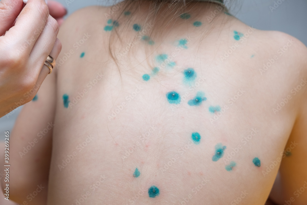 Stock-Foto „Child covered with green rashes the whole body ill with ...