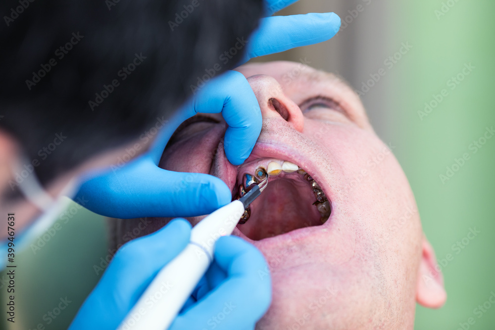 Dentist doctor treats a tooth to a patient close-up. Caries treatment ...