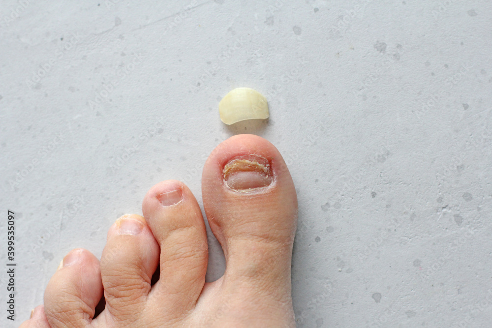 Foto Exfoliation of nail on big toe, close-up in woman, girl. Toenail ...