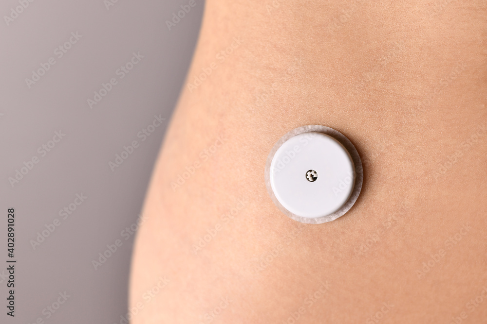 Glucose monitoring sensor system attached to skin of person with ...