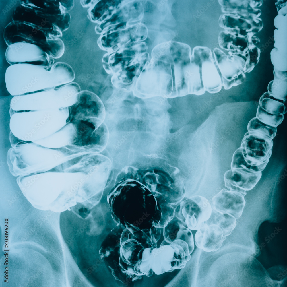 Bowel X-ray. Diseases of the digestive tract. Sick intestines. Stock ...