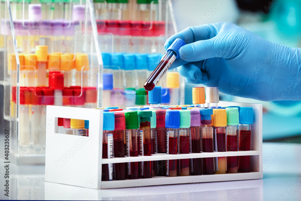 Doctor holding blood sample tube in the blood bank laboratory of the ...