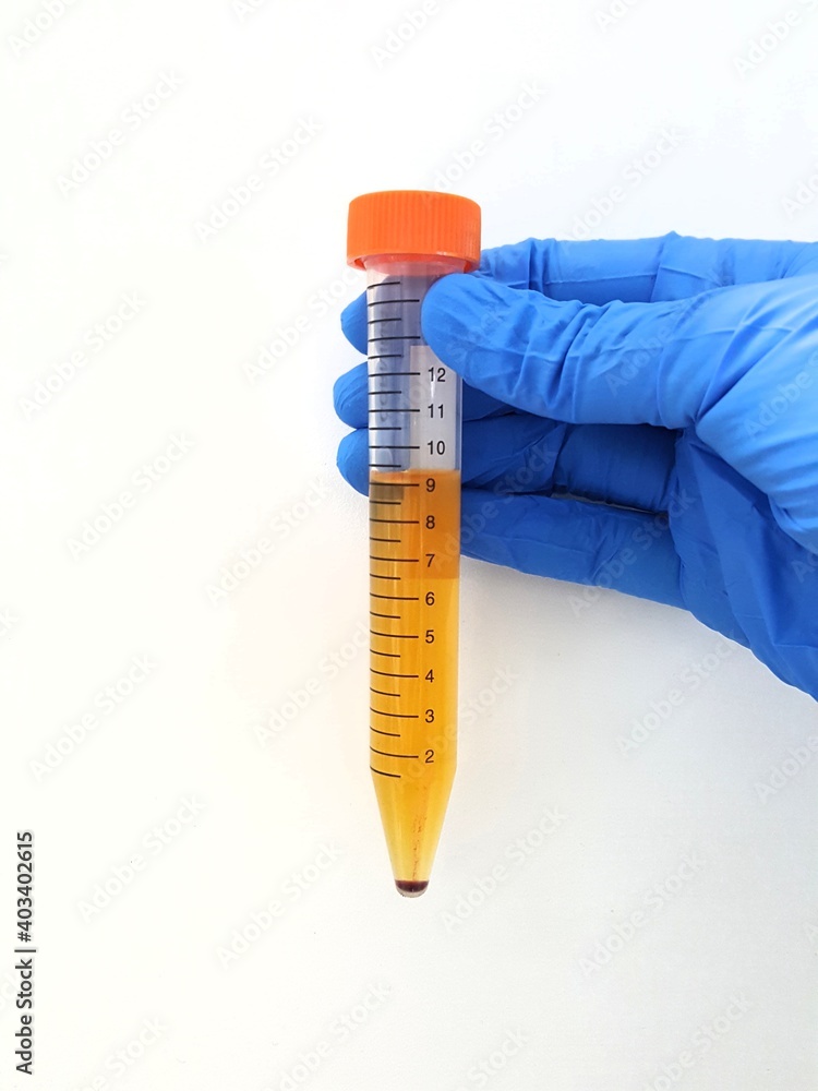 Urine samples for analysis in laboratory. Urinary red blood cells in ...