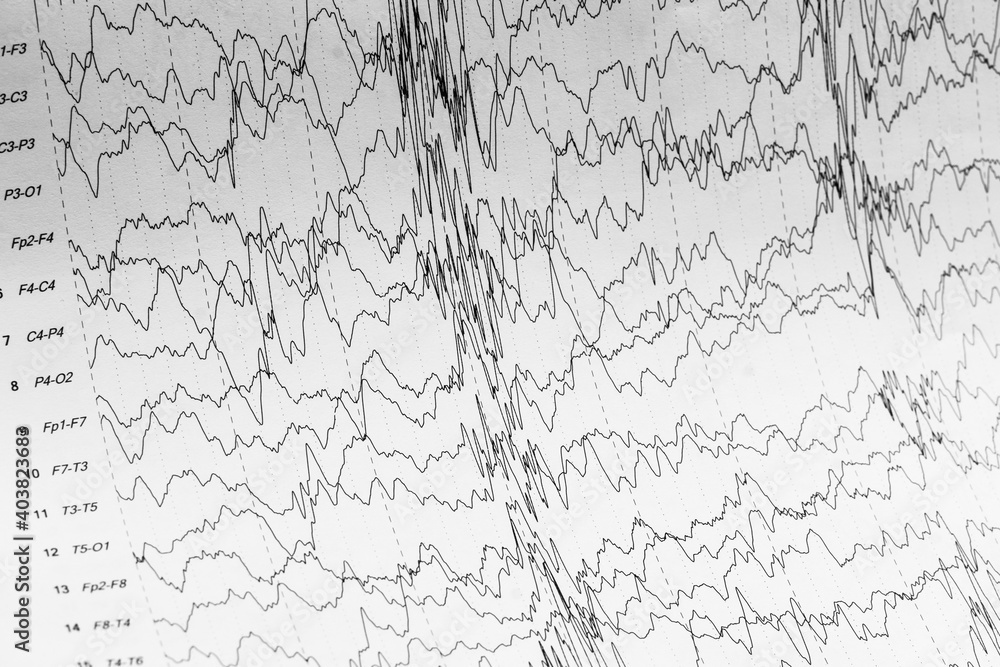 EEG wave form of the pediatric patients, problems in the electrical ...