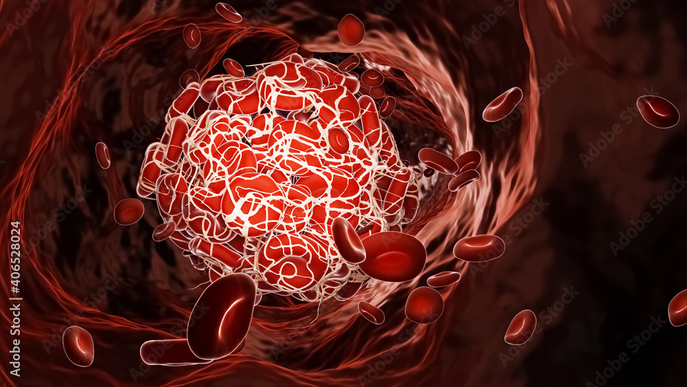 Thrombus or blood clot inside a blood vessel flowing with red blood ...