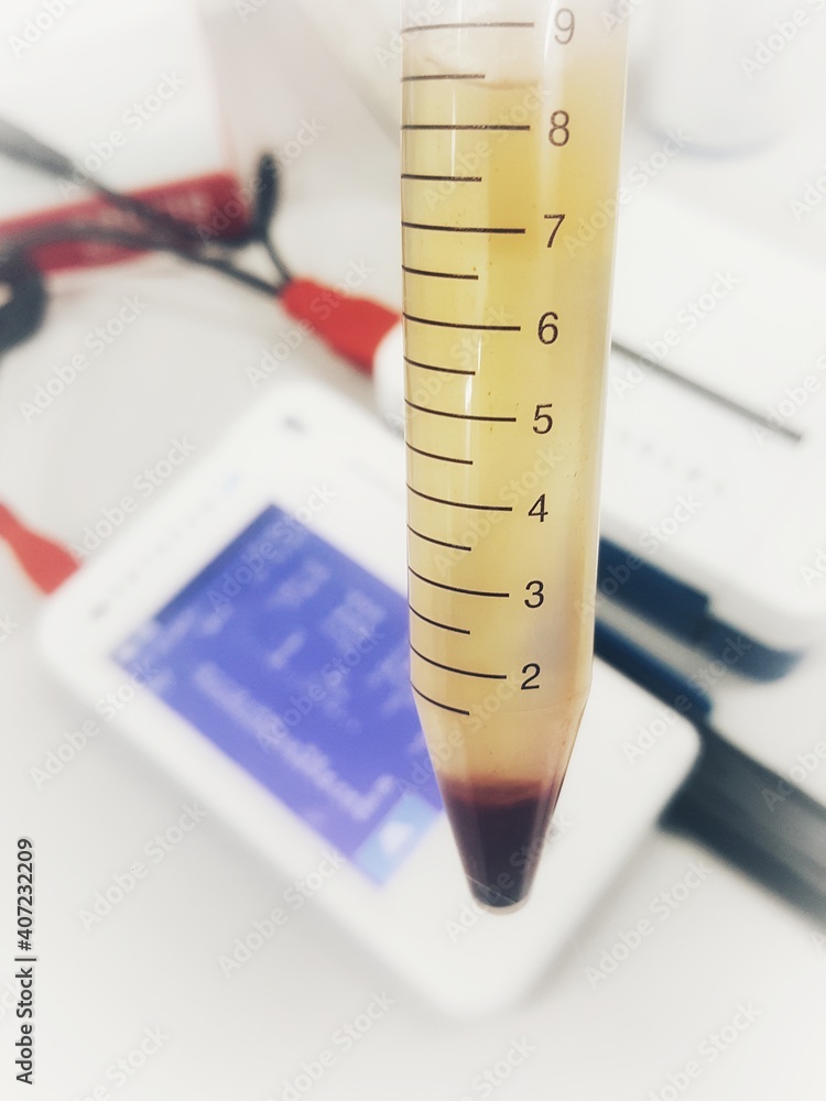 Urine samples for analysis in laboratory. Urinary red blood cells in ...