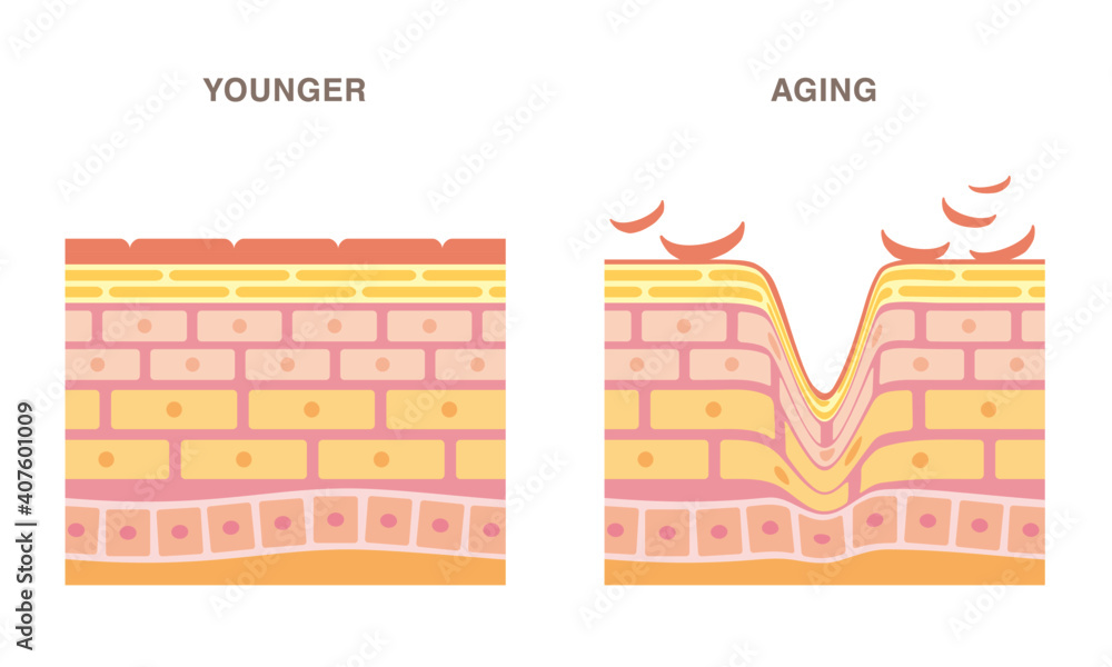 Skin cross section. Younger and aging. Smooth and wrinkled. Pale ...