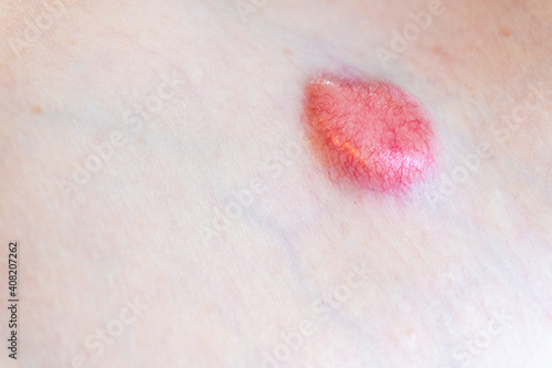 Raised dermatfibrosarcoma protuberans (DFSP, non-melanoma skin cancer ...