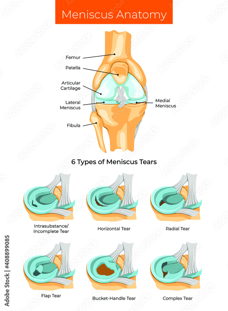 Vector illustration. Meniscus Anatomy and 6 Types of Meniscus Tears ...