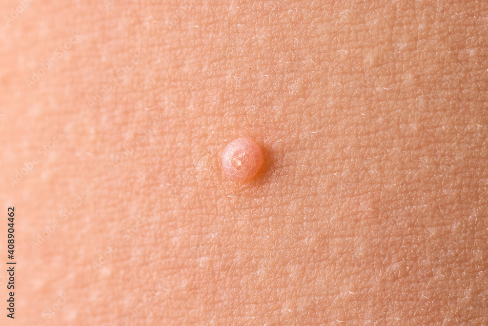 Detail of a molluscum contagiosum nodule produced by the ...