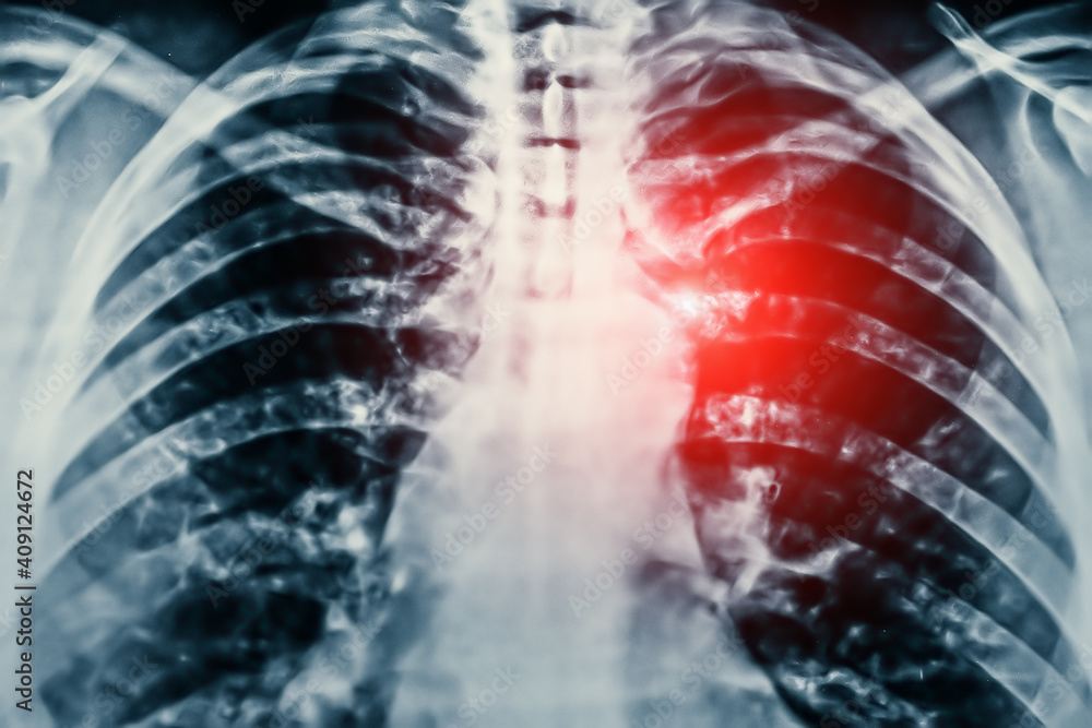 Chest x-ray, roentgen picture of human breast with bones and red spot ...