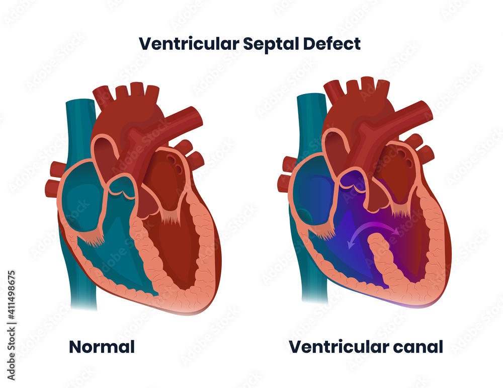 Ventricular septal defect with normal heart anatomy. Illustration of ...