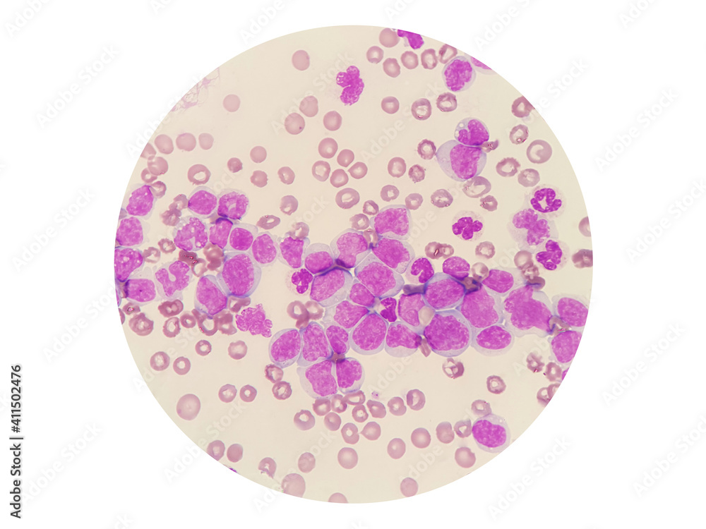 Acute myeloid leukemia (AML) is a type of blood cancer. Microscopic ...