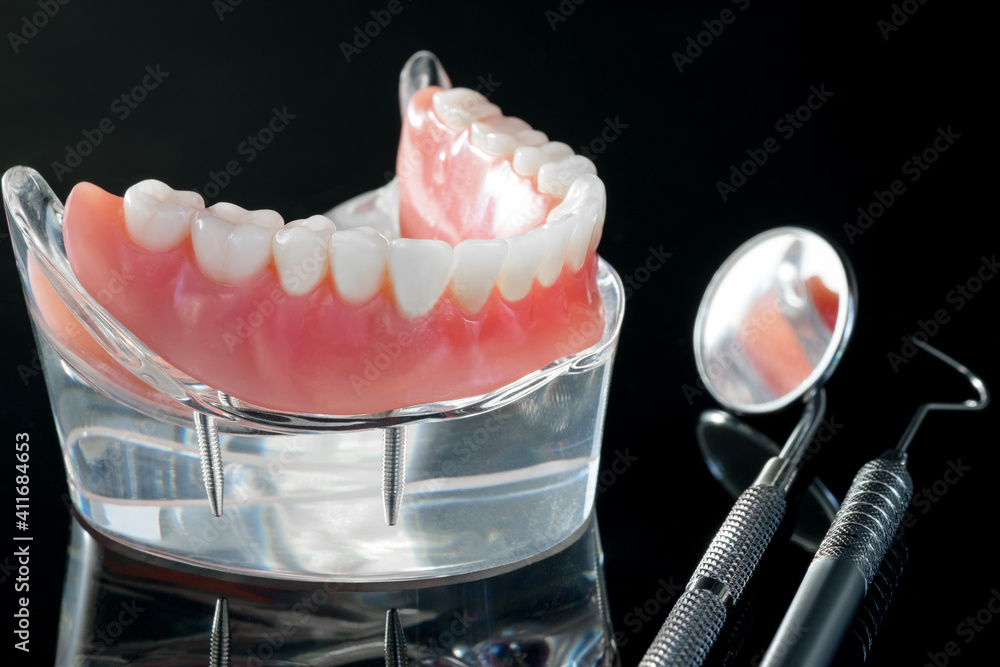 Teeth model showing an implant crown bridge model/ dental demonstration ...