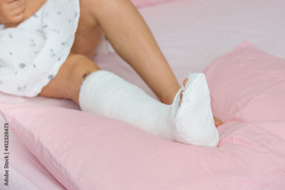 Leg in plaster of a teenage girl on a pink bed after an accidental fall ...