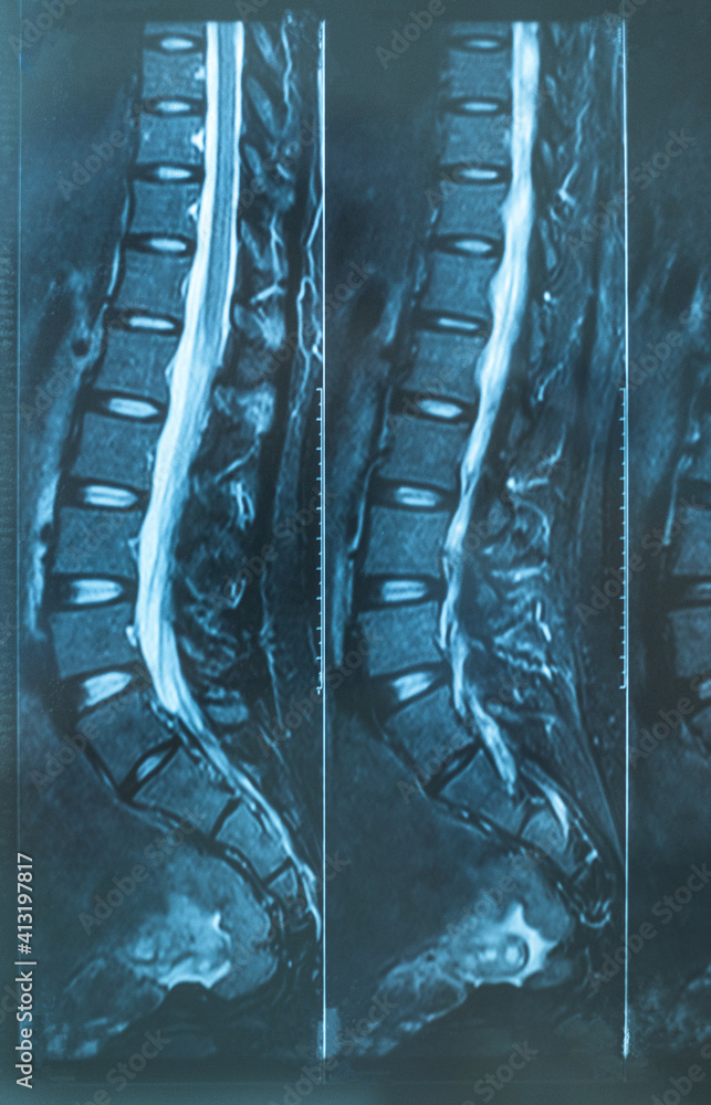 X- ray MRI of lumbosacral spine (L-S spine) case of low back pain ...