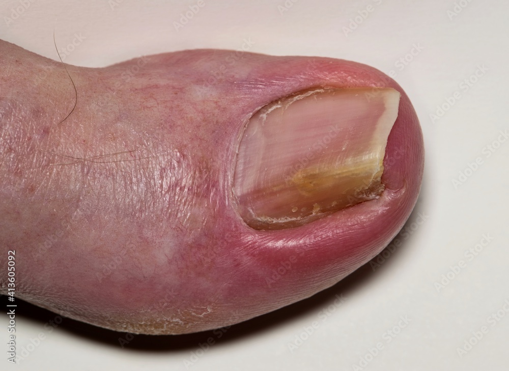 Ingrown toenail onychocryptosis on caucasian big toe Hallux, fungal ...